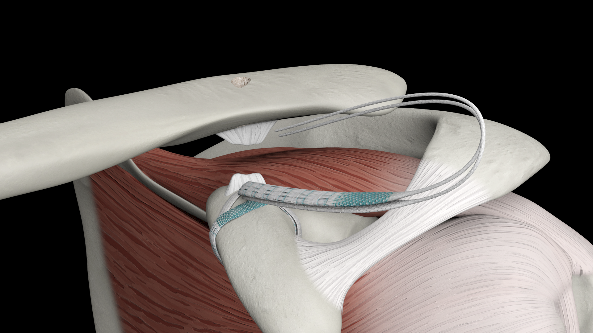 Infinity-Lock™ Button System - ASH 3D